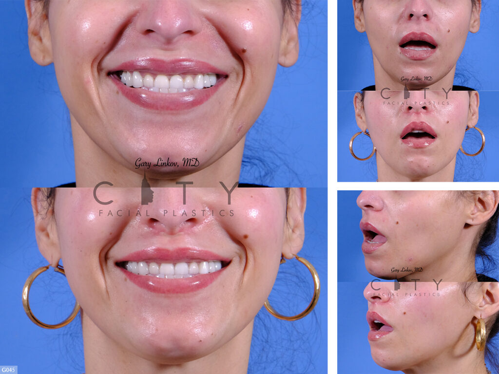Lip Lift Before and After | New York Plastic Surgeon Dr. Linkov