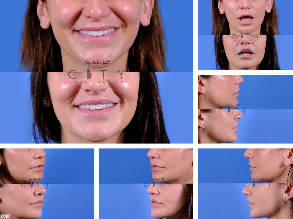Lip Lift Before and After | New York Plastic Surgeon Dr. Linkov