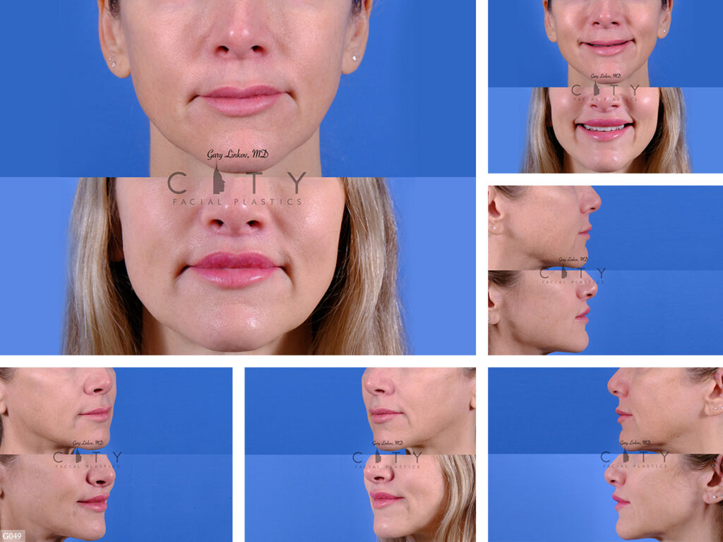 Lip Lift Before and After | New York Plastic Surgeon Dr. Linkov