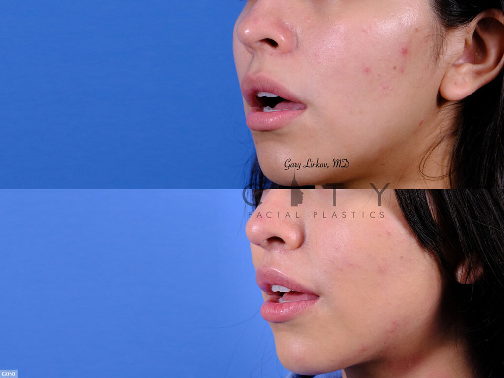 Lip Lift Before and After | New York Plastic Surgeon Dr. Linkov