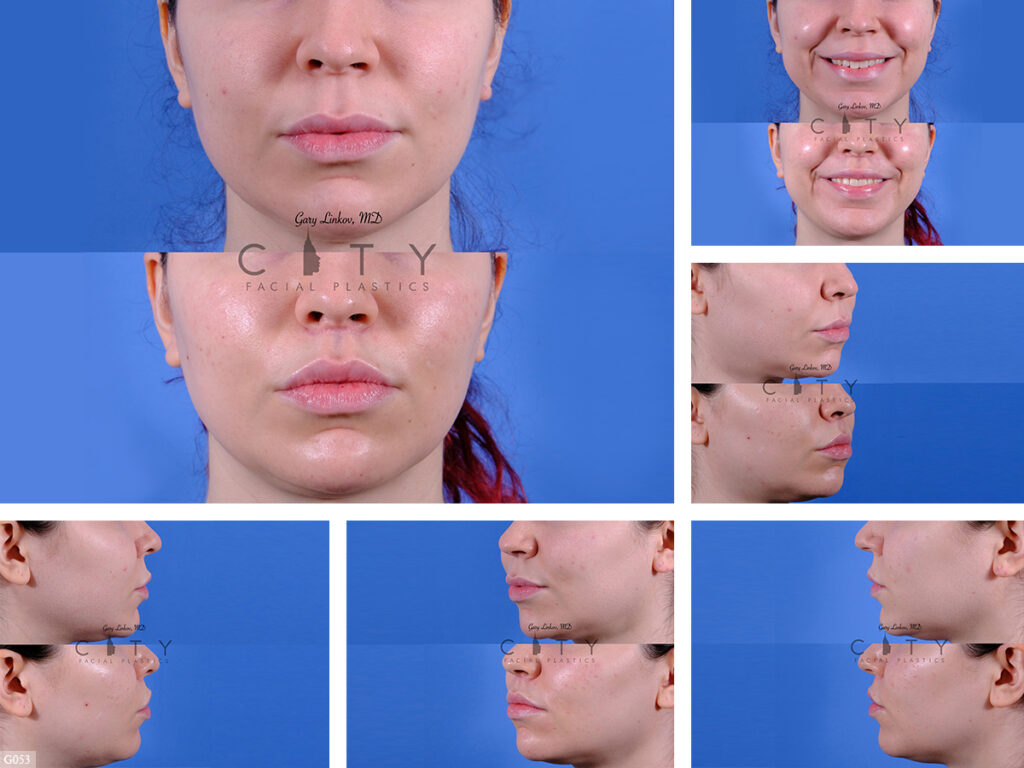 Lip Lift Before and After | New York Plastic Surgeon Dr. Linkov