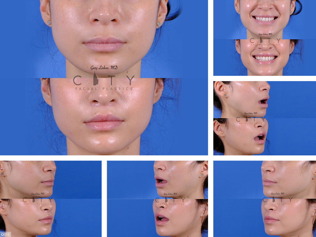 Lip Lift Before and After | New York Plastic Surgeon Dr. Linkov