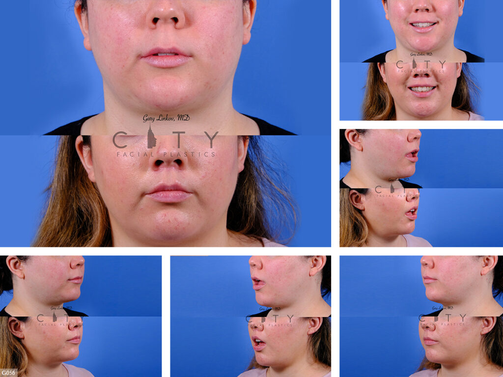 Lip Lift Before and After | New York Plastic Surgeon Dr. Linkov