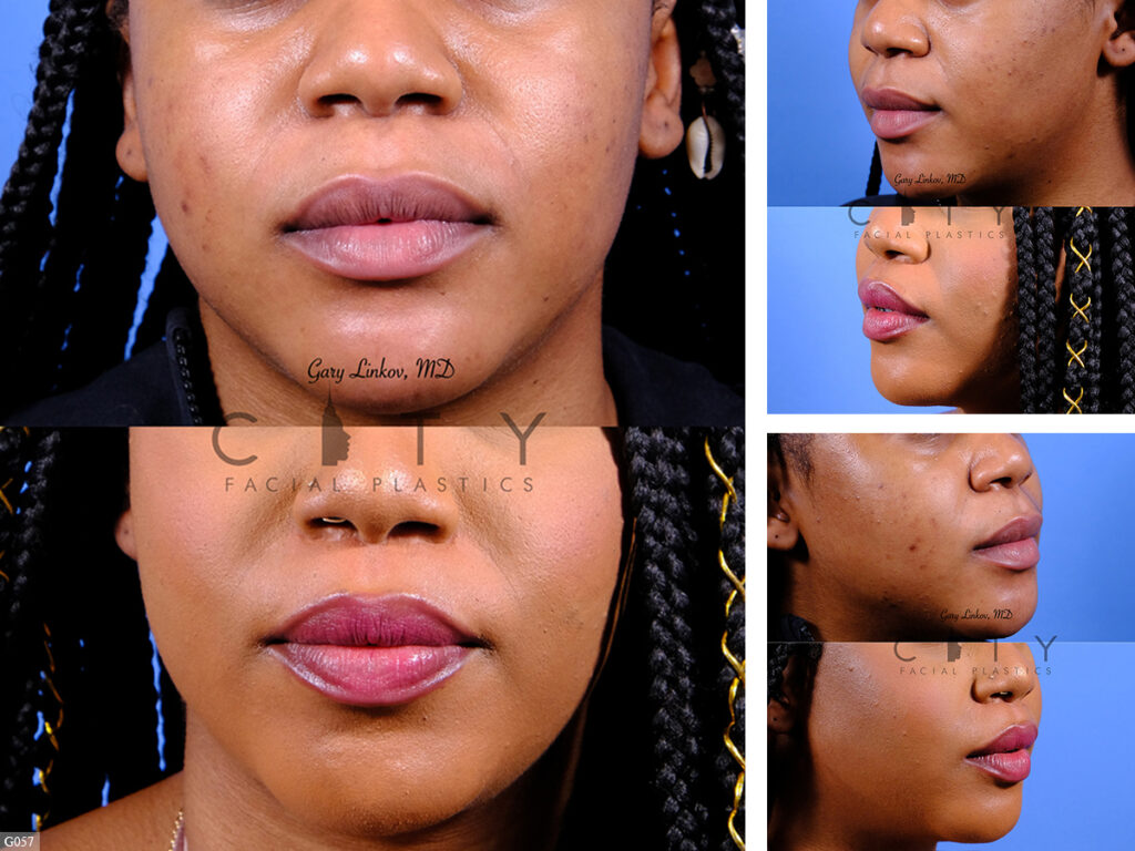 Lip Lift Before and After | New York Plastic Surgeon Dr. Linkov