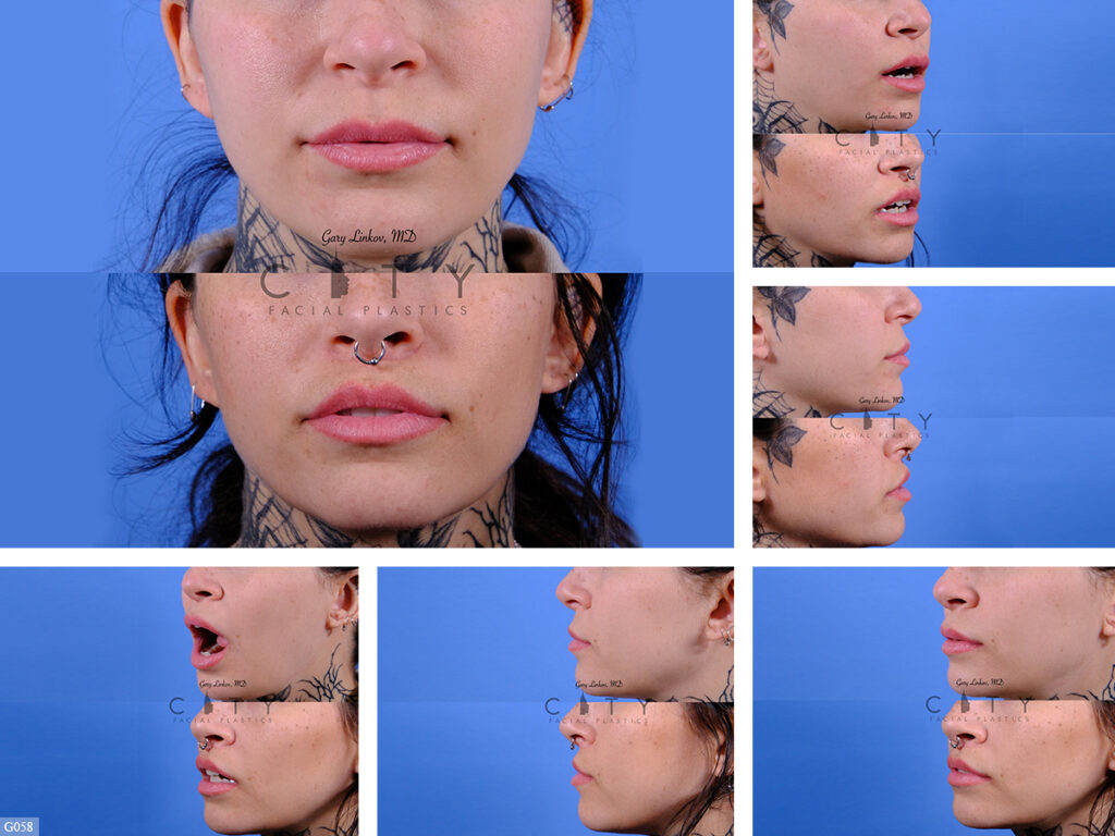 Lip Lift Before and After | New York Plastic Surgeon Dr. Linkov