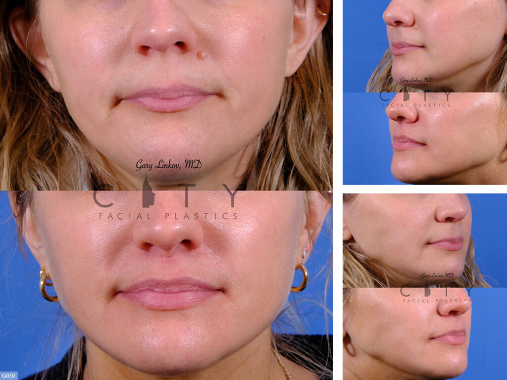 Lip Lift Before and After | New York Plastic Surgeon Dr. Linkov