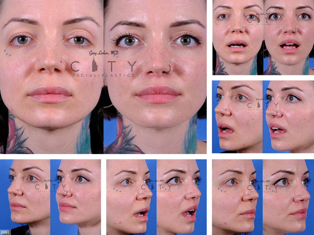 Lip Lift Before and After | New York Plastic Surgeon Dr. Linkov