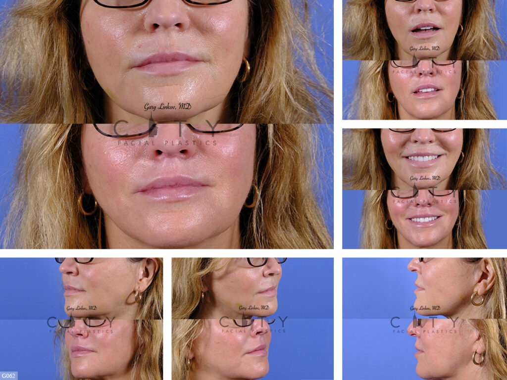 Lip Lift Before and After | New York Plastic Surgeon Dr. Linkov