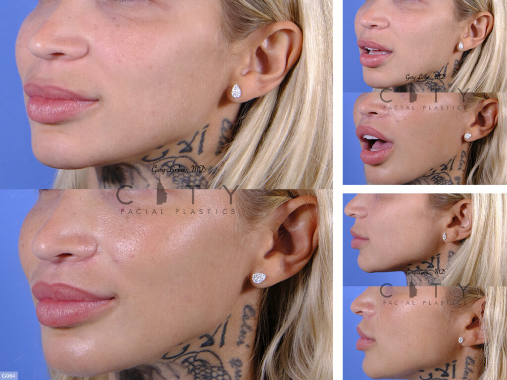 Lip Lift Before and After | New York Plastic Surgeon Dr. Linkov