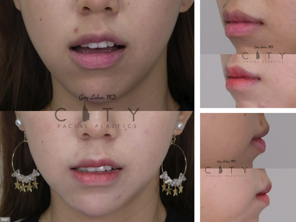 NYC Lip Reduction Before and After Pictures | New York | UES