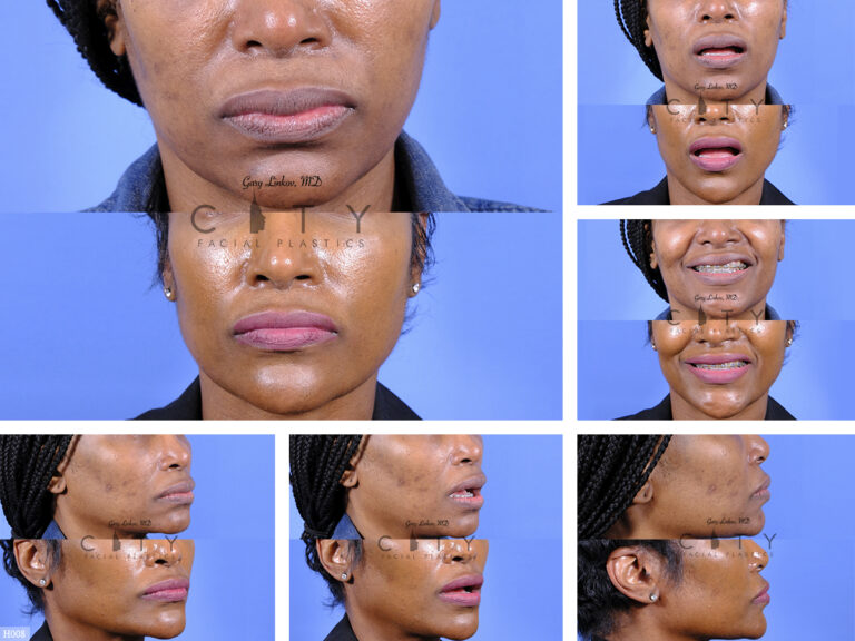 NYC Lip Reduction Before and After Pictures | New York | UES