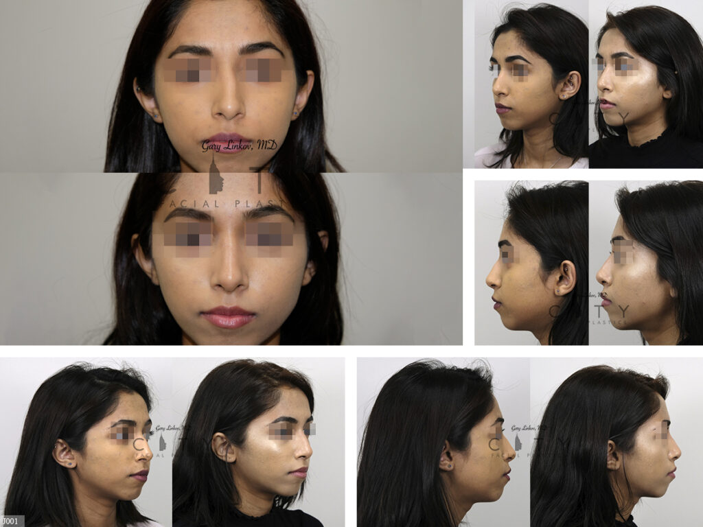 NYC Nasal Surgery (Rhinoplasty) Before and After Pictures - New York - UES