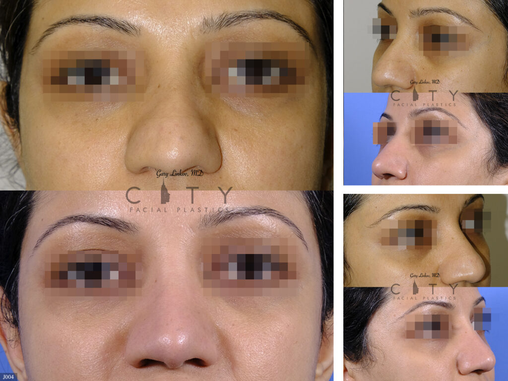 NYC Nasal Surgery (Rhinoplasty) Before and After Pictures - New York - UES