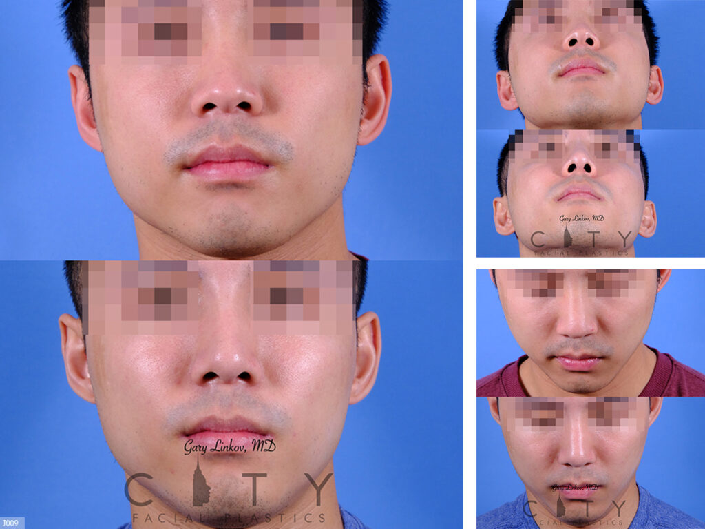 NYC Nasal Surgery (Rhinoplasty) Before and After Pictures - New York - UES