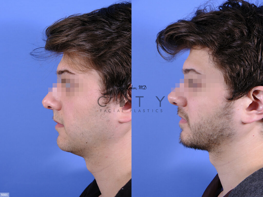 NYC Submental Liposuction Before and After Pictures - New York - UES