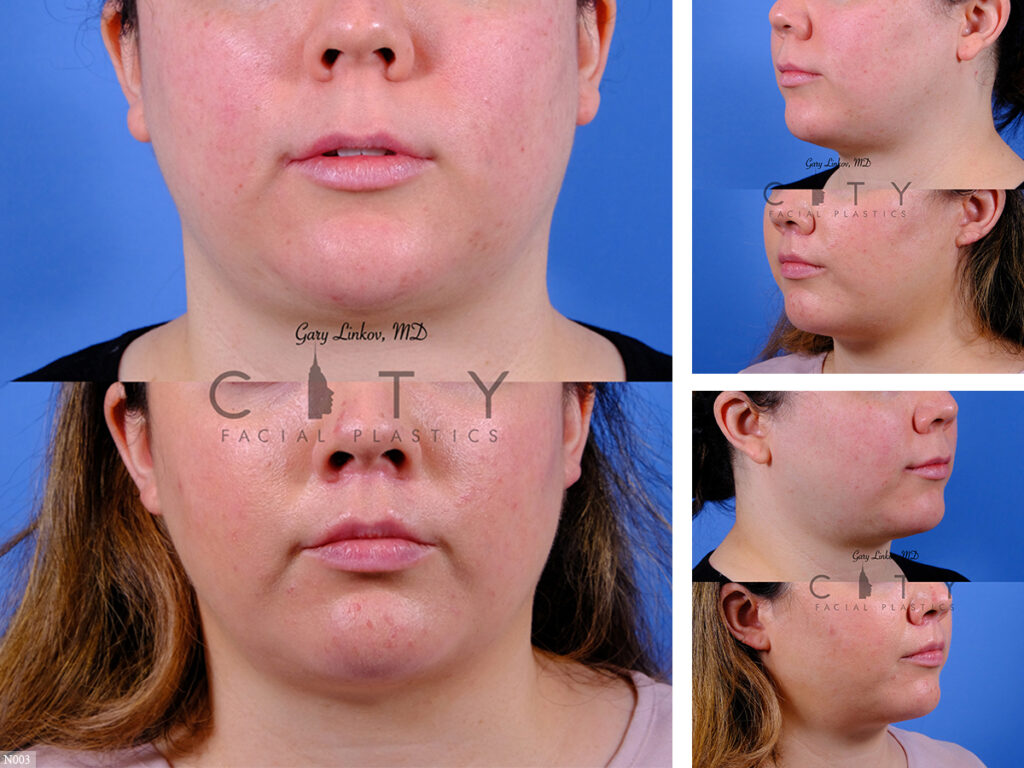 NYC Submental Liposuction Before and After Pictures - New York - UES