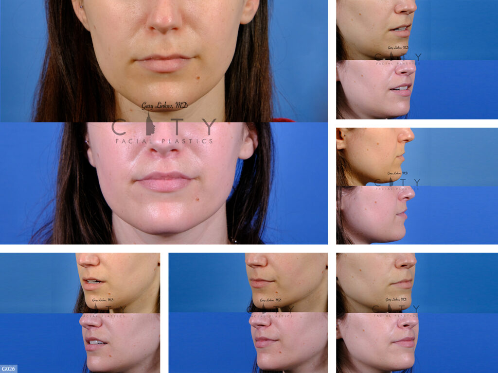 Lip Lift Before and After | New York Plastic Surgeon Dr. Linkov