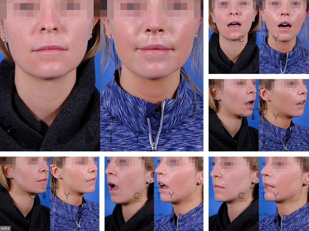 Lip Lift Before and After | New York Plastic Surgeon Dr. Linkov