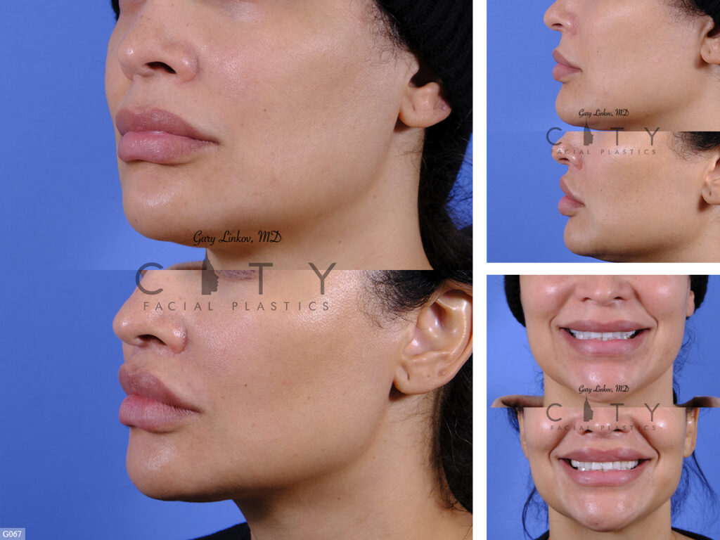 Lip Lift Before and After | New York Plastic Surgeon Dr. Linkov