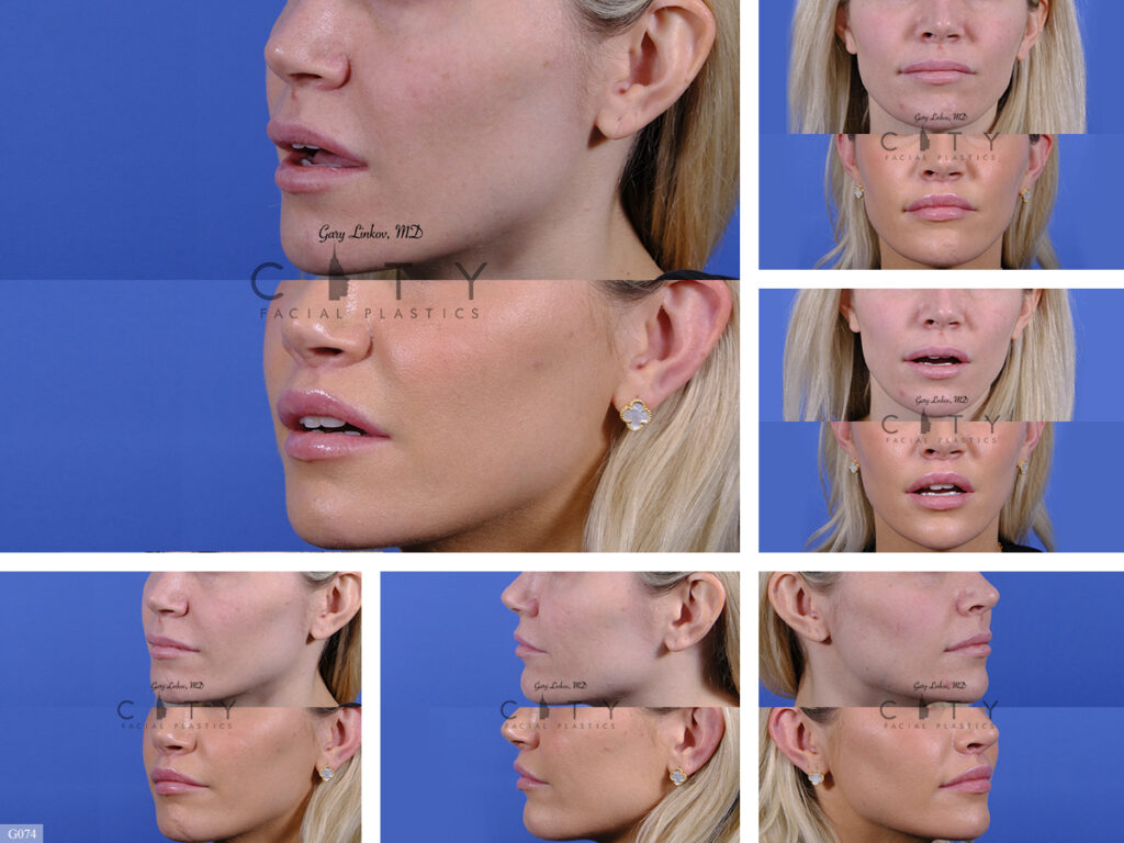 Lip Lift Before and After | New York Plastic Surgeon Dr. Linkov