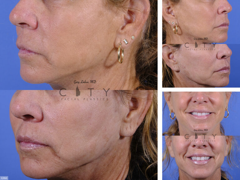 Lip Lift Before and After | New York Plastic Surgeon Dr. Linkov