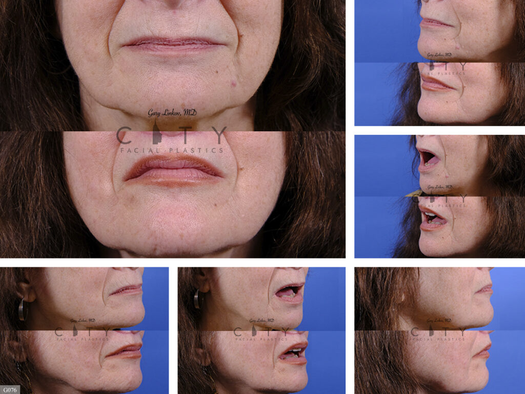 Lip Lift Before and After | New York Plastic Surgeon Dr. Linkov