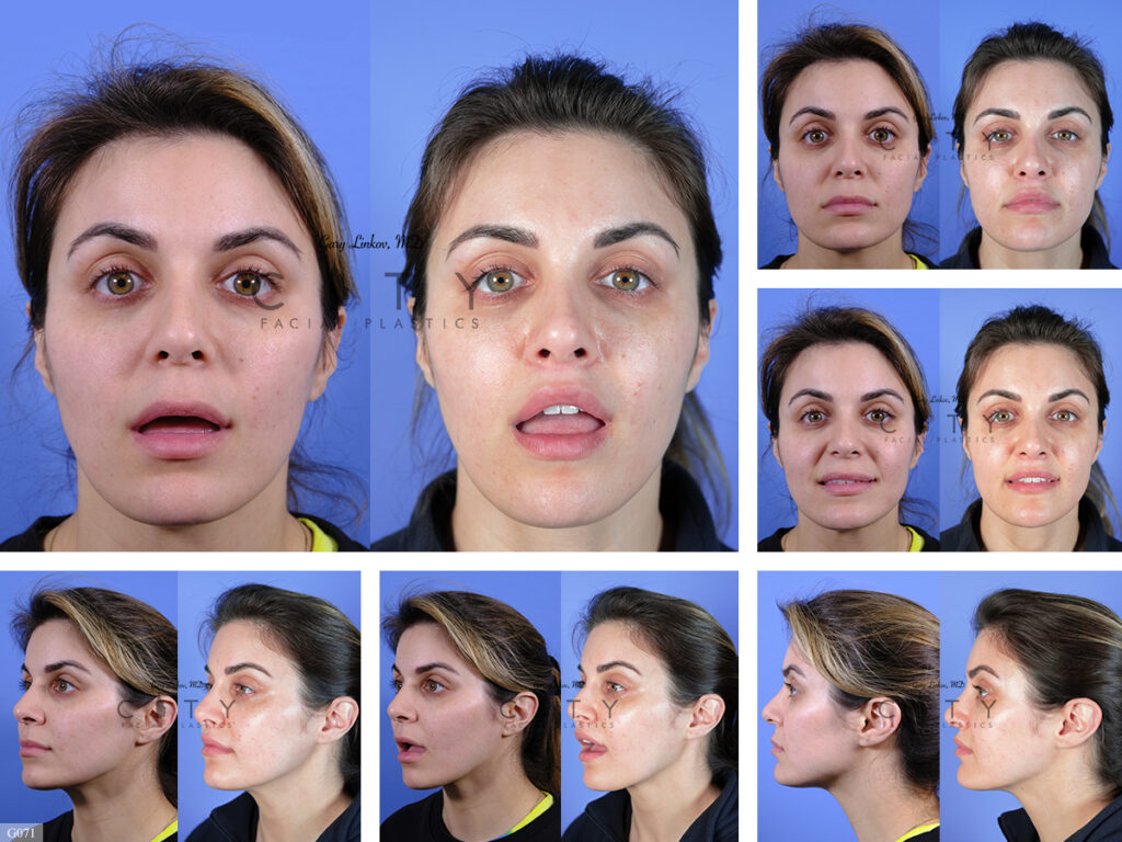 Lip Lift Before and After | New York Plastic Surgeon Dr. Linkov