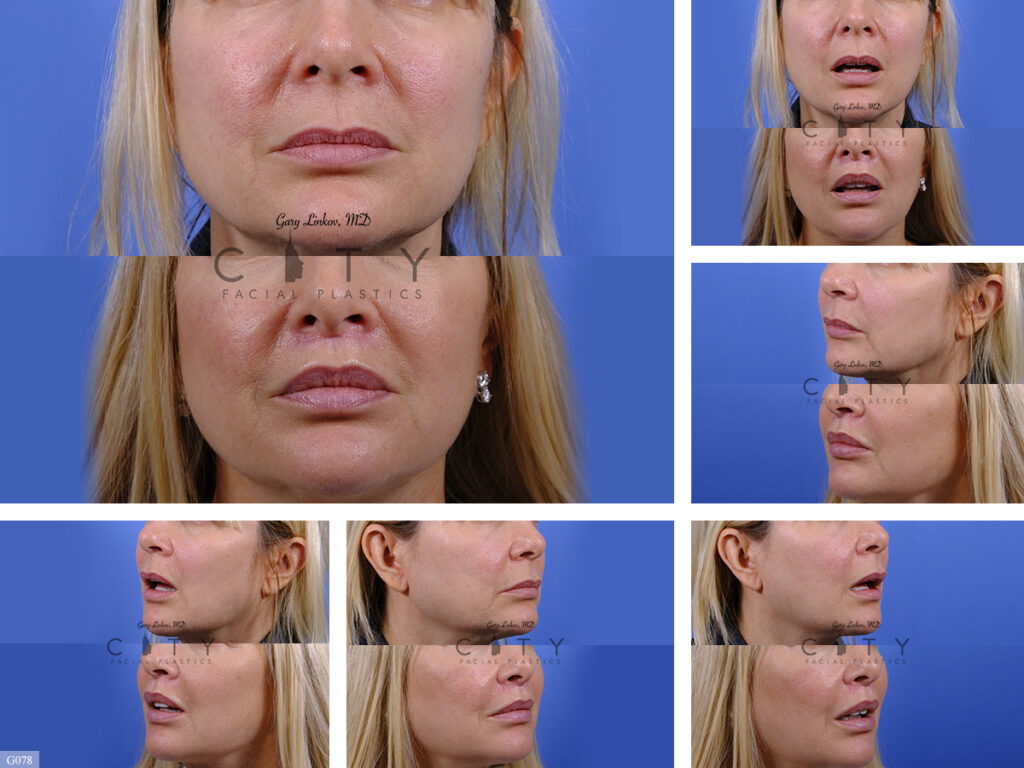 Lip Lift Before and After | New York Plastic Surgeon Dr. Linkov