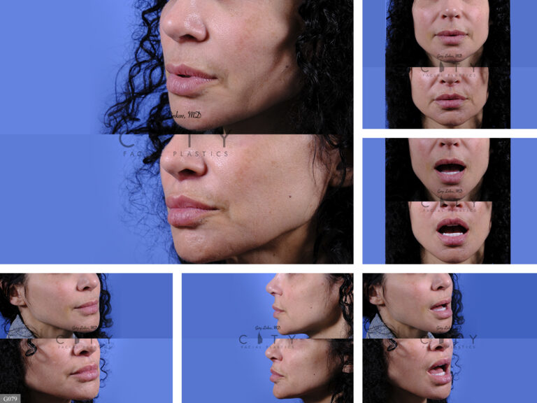 Lip Lift Before and After | New York Plastic Surgeon Dr. Linkov
