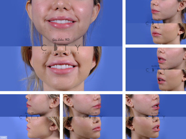 Lip Lift Before and After | New York Plastic Surgeon Dr. Linkov