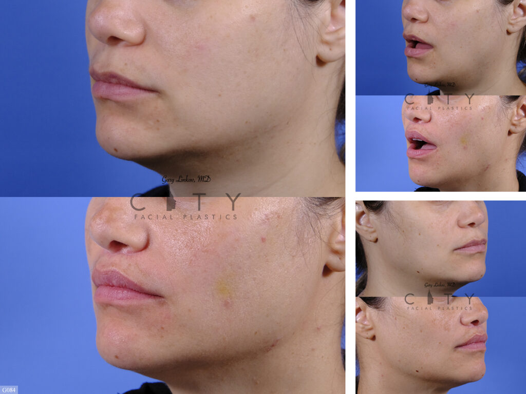 Lip Lift Before and After | New York Plastic Surgeon Dr. Linkov