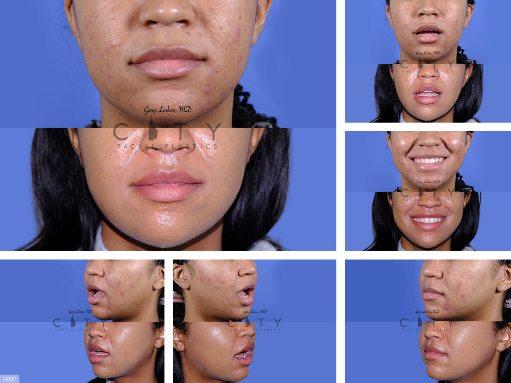 Lip Lift Before and After | New York Plastic Surgeon Dr. Linkov