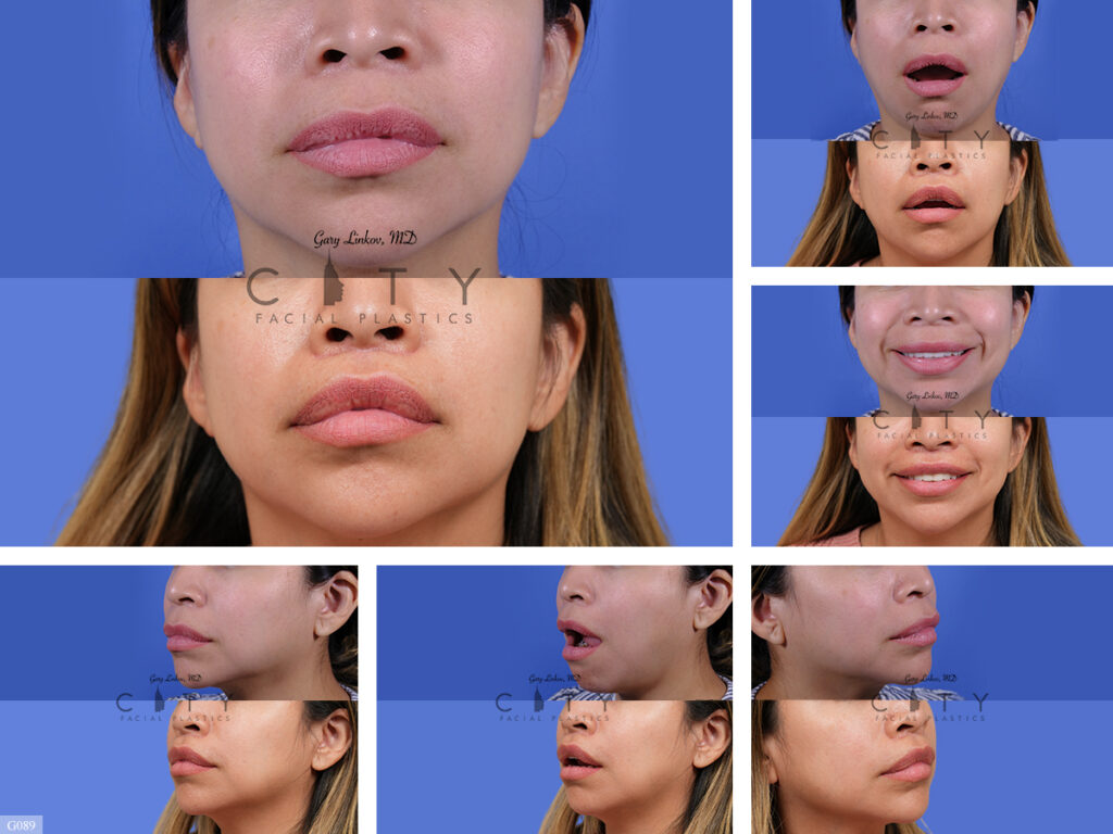 Lip Lift Before and After | New York Plastic Surgeon Dr. Linkov