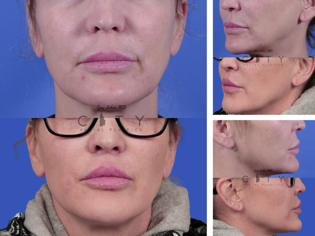 Lip Lift Before and After | New York Plastic Surgeon Dr. Linkov