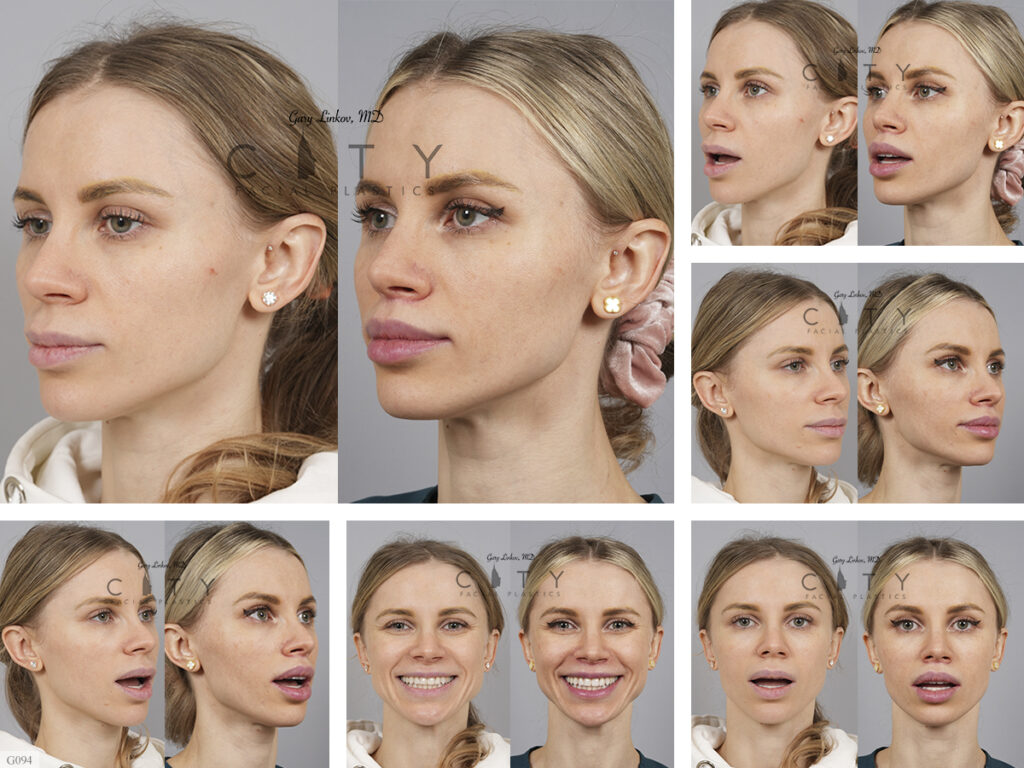 Lip Lift Before and After | New York Plastic Surgeon Dr. Linkov