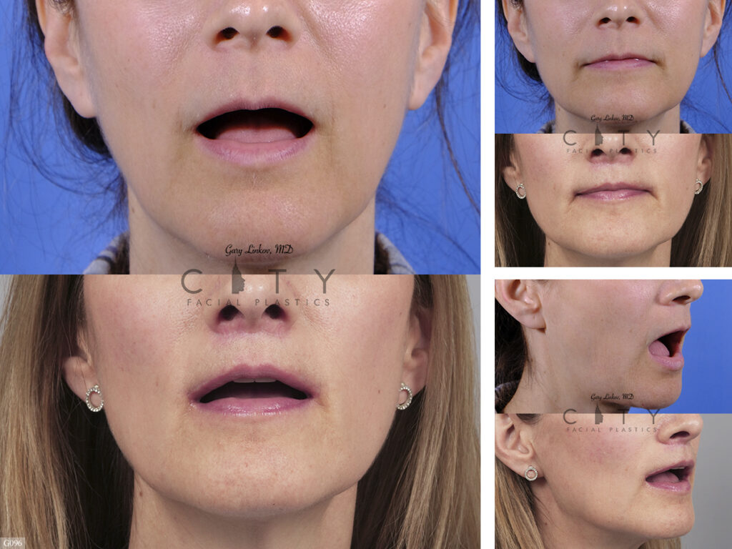 Lip Lift Before and After | New York Plastic Surgeon Dr. Linkov