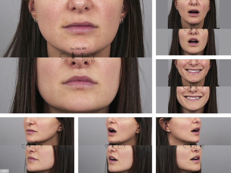 Lip Lift Before and After | New York Plastic Surgeon Dr. Linkov