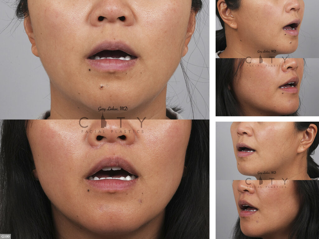 Lip Lift Before and After | New York Plastic Surgeon Dr. Linkov