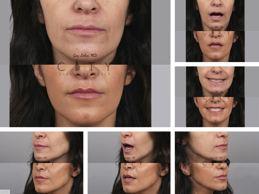 Lip Lift Before and After | New York Plastic Surgeon Dr. Linkov