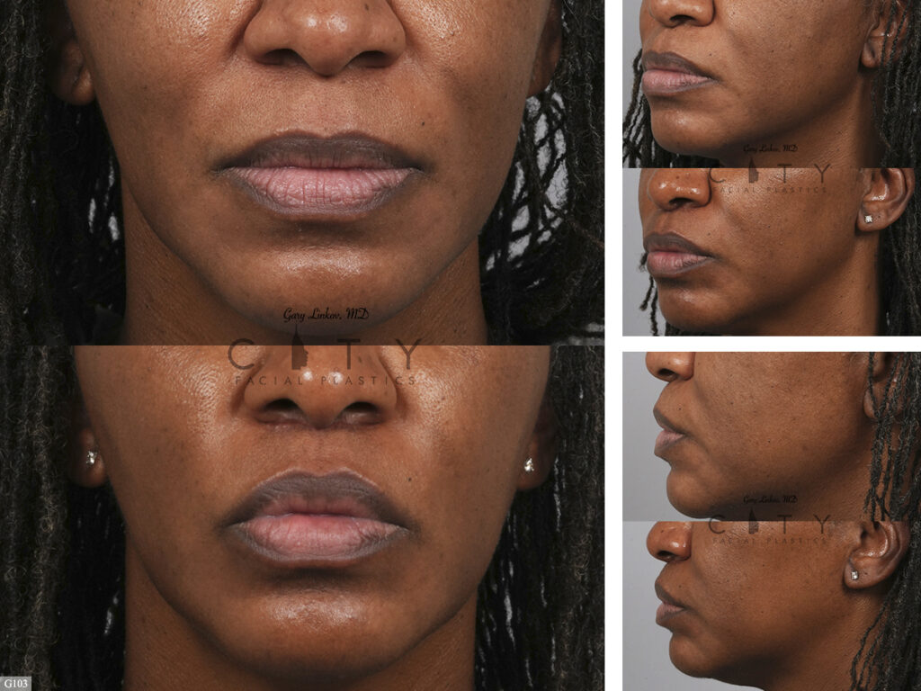 Lip Lift Before and After | New York Plastic Surgeon Dr. Linkov