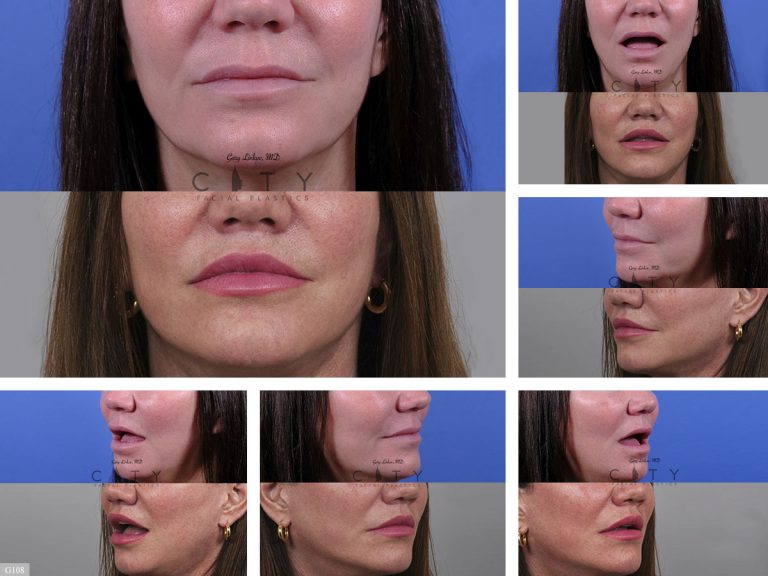 Lip Lift Before and After | New York Plastic Surgeon Dr. Linkov