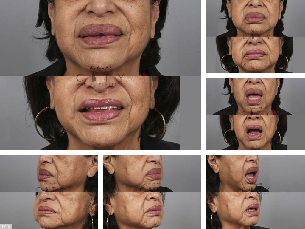 NYC Lip Reduction Before and After Pictures | New York | UES