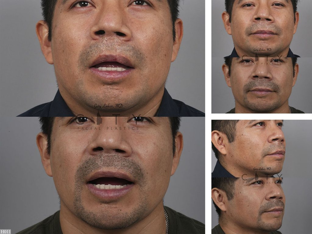 NYC Lip Reduction Before and After Pictures | New York | UES