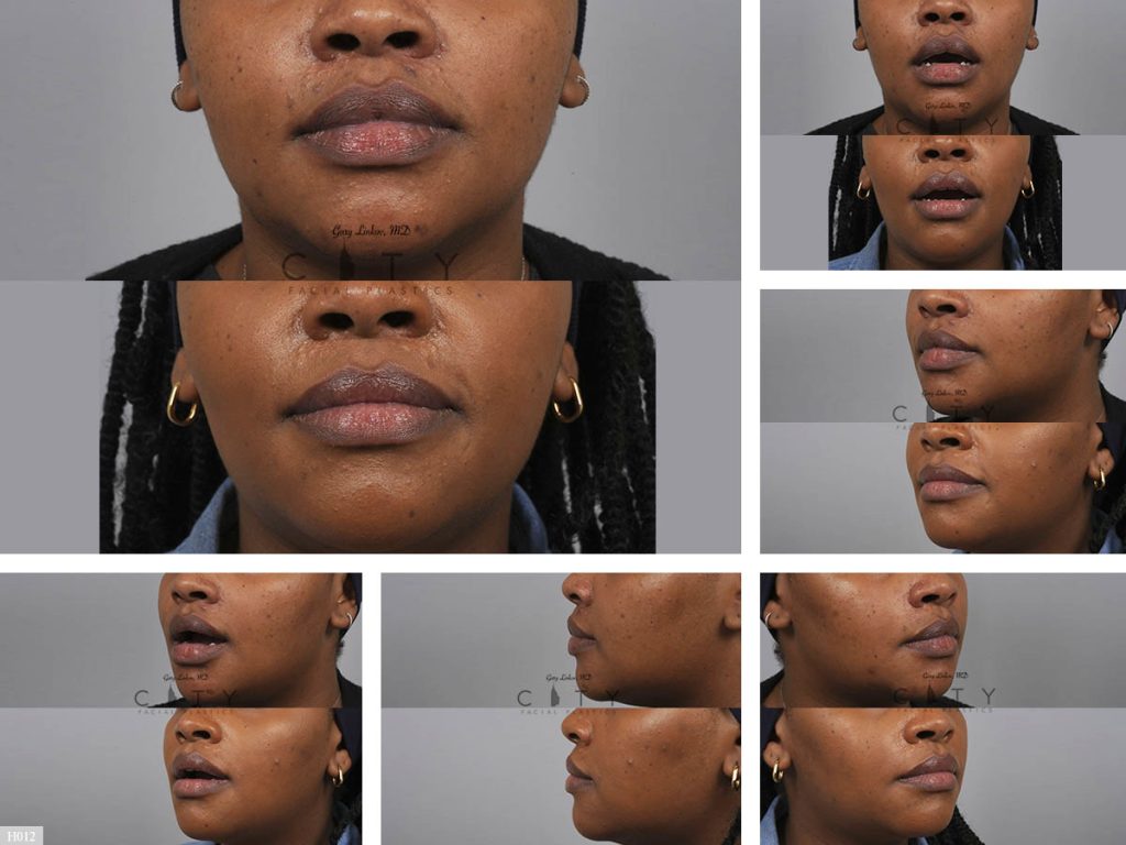 NYC Lip Reduction Before and After Pictures | New York | UES