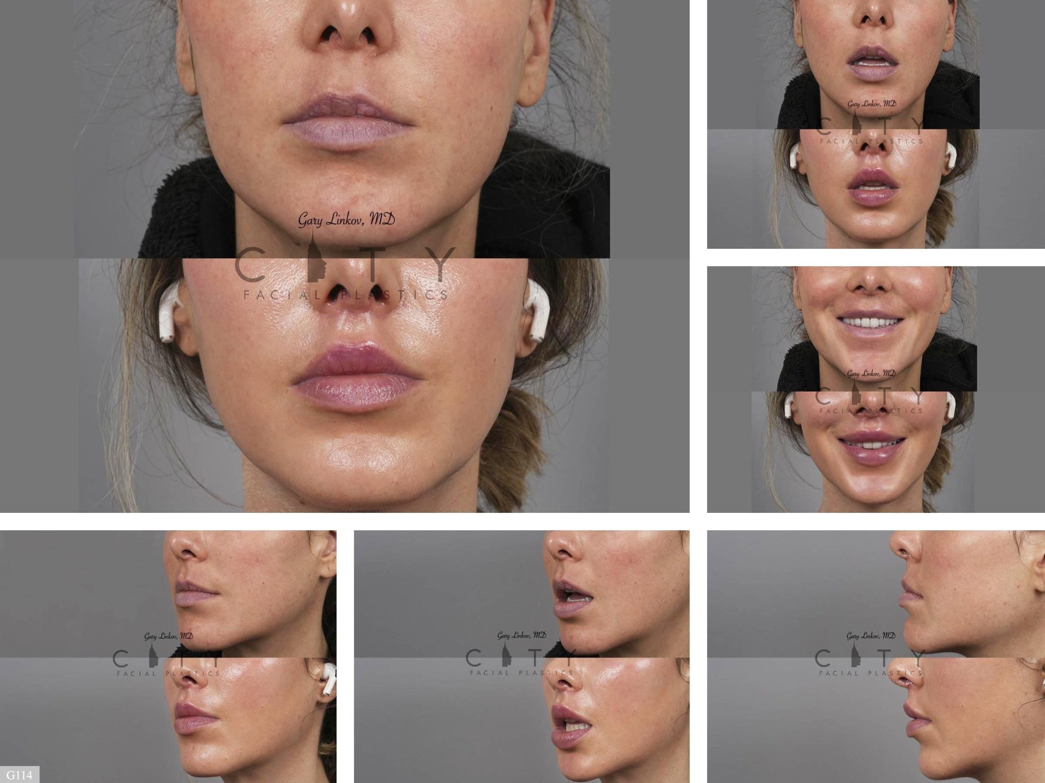 Lip Lift Before and After | New York Plastic Surgeon Dr. Linkov